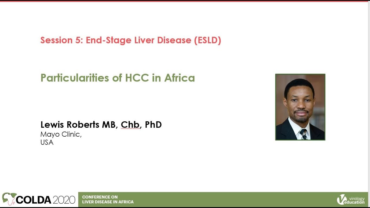Particularities of HCC in Africa | Lewis Roberts, MB, Chb, PhD