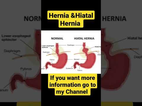 Definition of Normal Hernia & Hiatal Hernia Causes