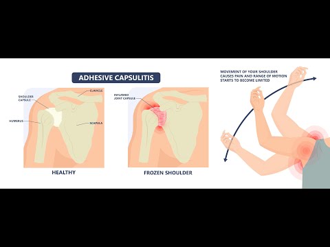 Frozen Shoulder (Adhesive Capsulitis)
