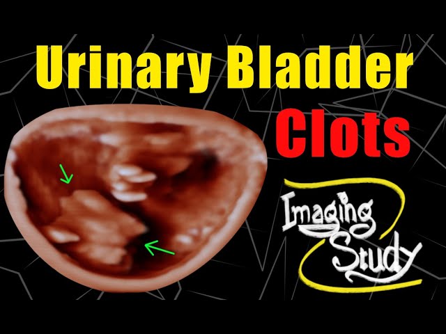 Understanding Urinary Bladder Clots: A Case Study | Galaxy.ai