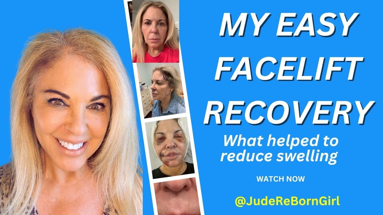 Reduce Swelling After Your Facelift! (What Worked For Me…)