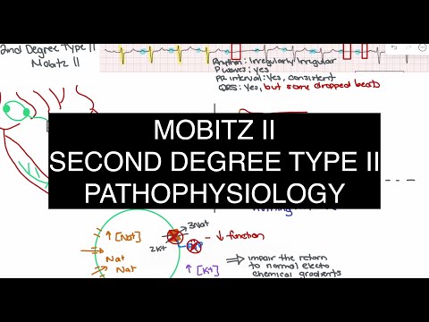 Understanding Mobitz Type II (Second-Degree Heart Block) – ECG Analysis & Pathophysiology