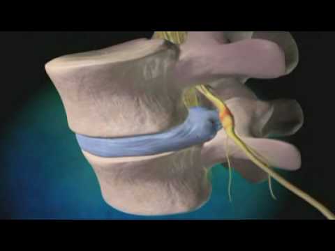 Comment soigner discopathie l5-s1 ? La réponse est sur Admicile.fr