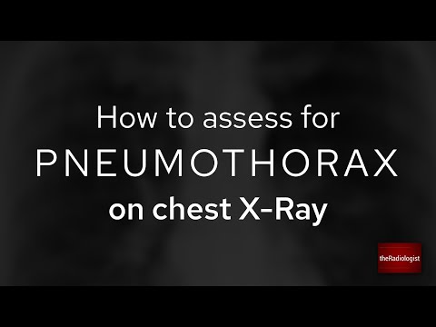 How to look for a pneumothorax on a frontal chest X-ray