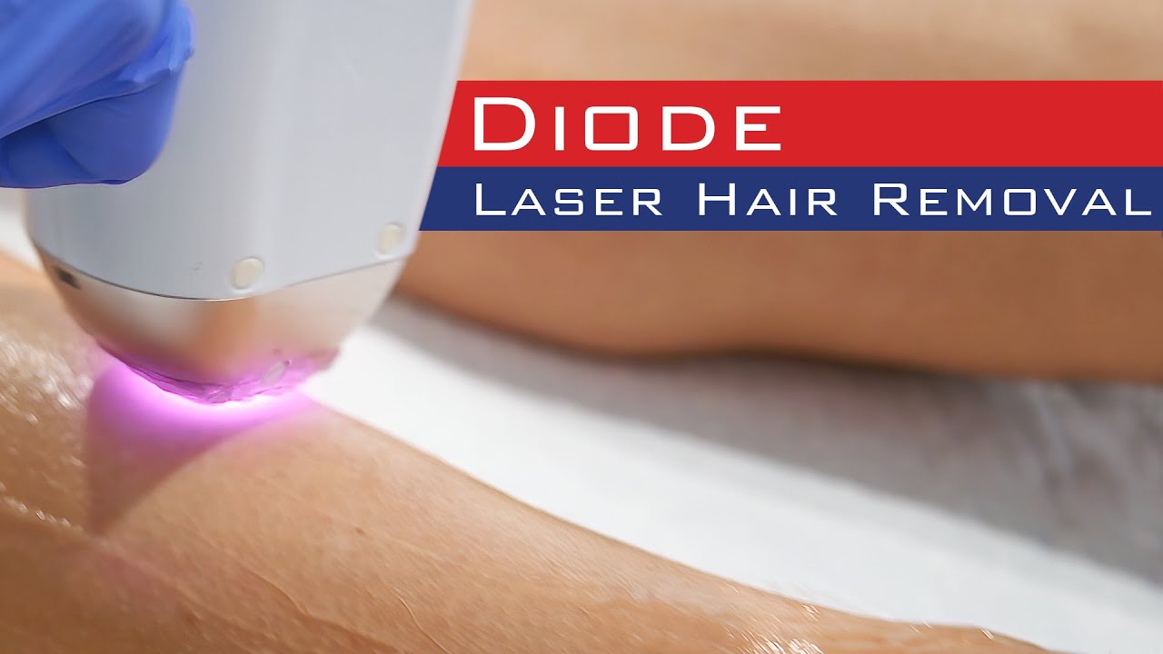 The Benefits of Diode Laser Hair Removal - The MediDiode