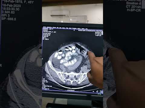 ASCITES IN ABDOMEN, CT SCAN ABDOMEN.NCCT SCAN CT SCAN ABDOMEN
