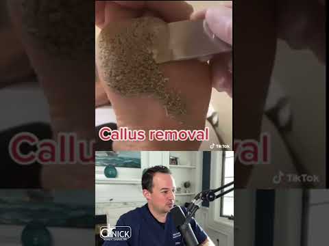 DOCTOR REACTS TO CALLUS REMOVAL! 😱 #shorts #reaction