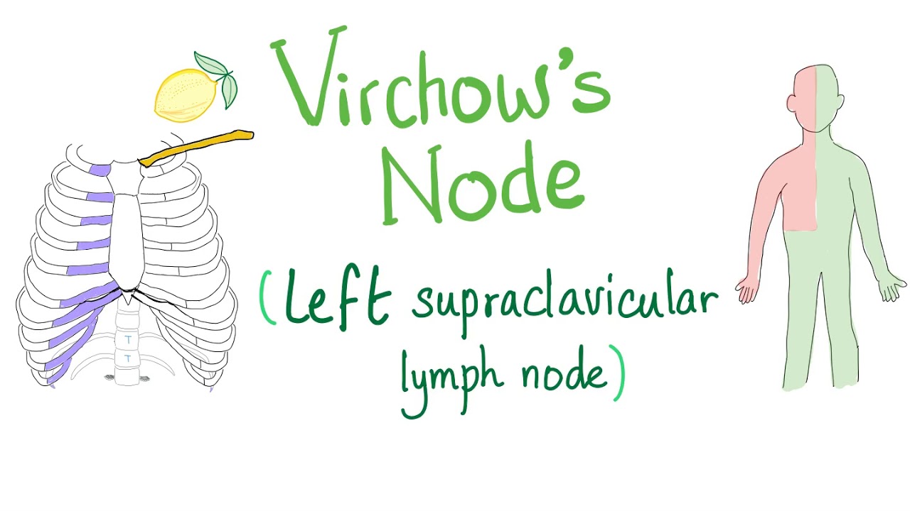 Virchow's Node (Left Supraclavicular Lymph Node) - Cancer - Oncology