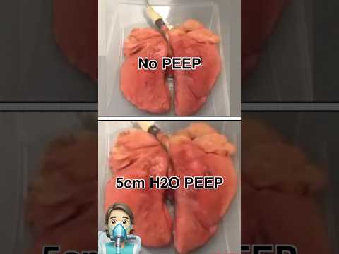 P.E.E.P. in 60 seconds - DOCTOR Explains! 🫁 #ScienceFacts #CriticalCare #Medicine