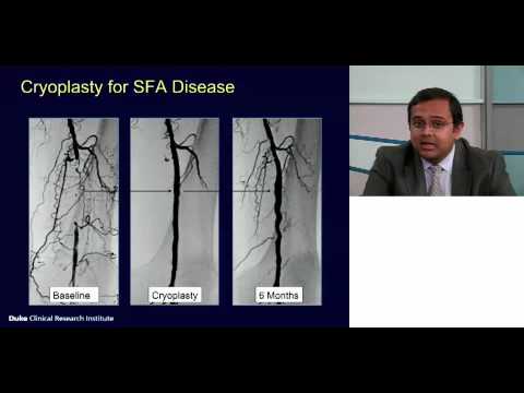 Medical and interventional management of peripheral arterial disease (PAD) in patients with diabetes