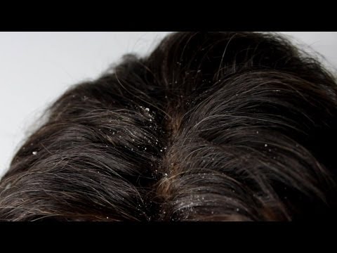 Comment traiter les squames du cuir chevelu ? La réponse est sur ...