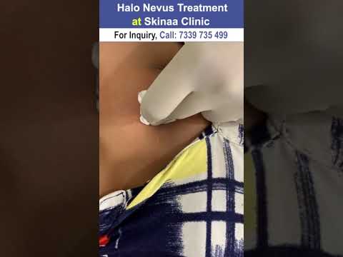 Halo Nevus at skinaa clinic #halo #halonevus #skinaaclinic #skinaa_clinic