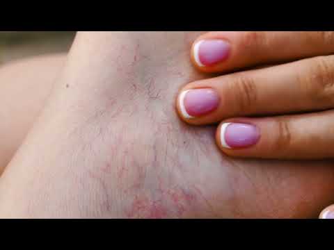 Peripheral Vascular Disease