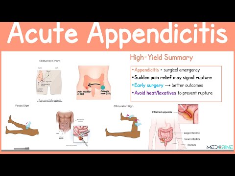 Acute Appendicitis Explained | Pathophysiology, Diagnosis, and Management | High-yield tutorial