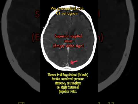 Diagnosis on CT brain #radiology #imagingdiagnosis #radiologicaldiagnosis #medicalstudent #ctscan