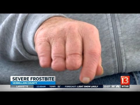 Indiana man who lost 9 fingertips from frostbite speaks