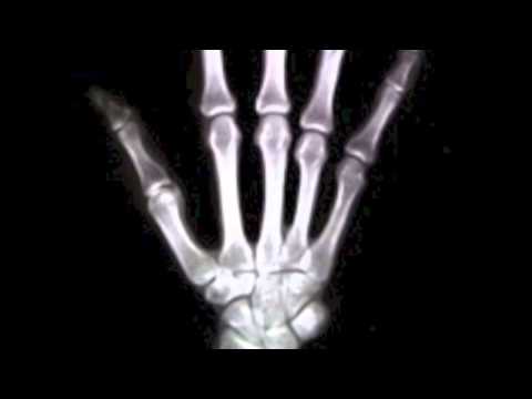 Metacarpophalangeal Joint & Rheumatoid Arthritis
