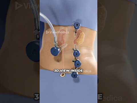 Robot-Assisted Human Kidney Removal (3D Animation)
