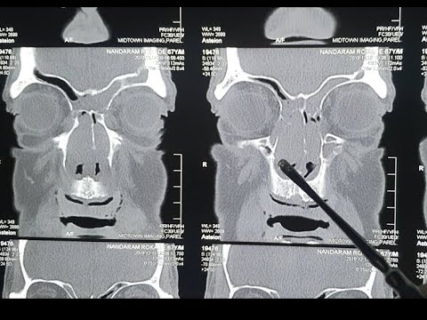 PART 1: ROSAI-DORFMAN disease of nose explained on CT PNS with basics. Dr.Ajinkya Kedari