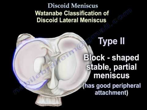 Discoid Meniscus - Everything You Need To Know - Dr. Nabil Ebraheim