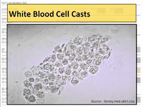 Microscopic Urine Sediment - Part 3 - Casts