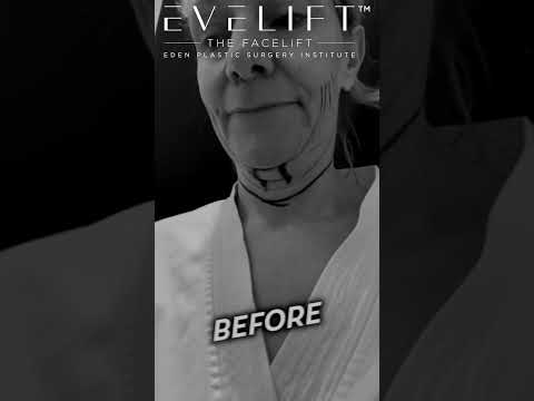EVE Lift™ Before And After | Eden Plastic Surgery: Dr. Ali Charafeddine, MD