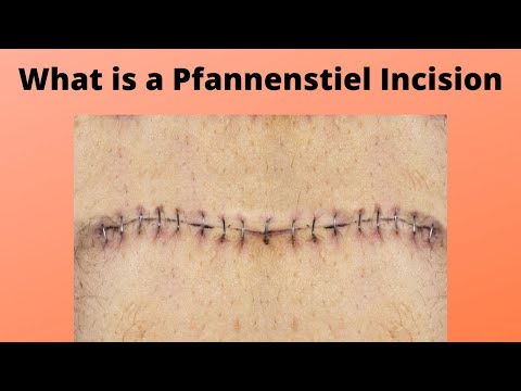 What is a Pfannenstiel Incision