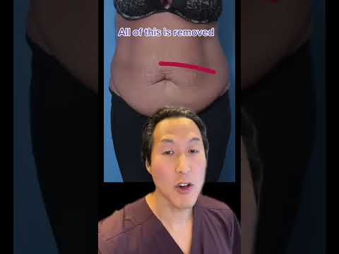 Watch This Tummy Transformation! #shorts #tummytuck