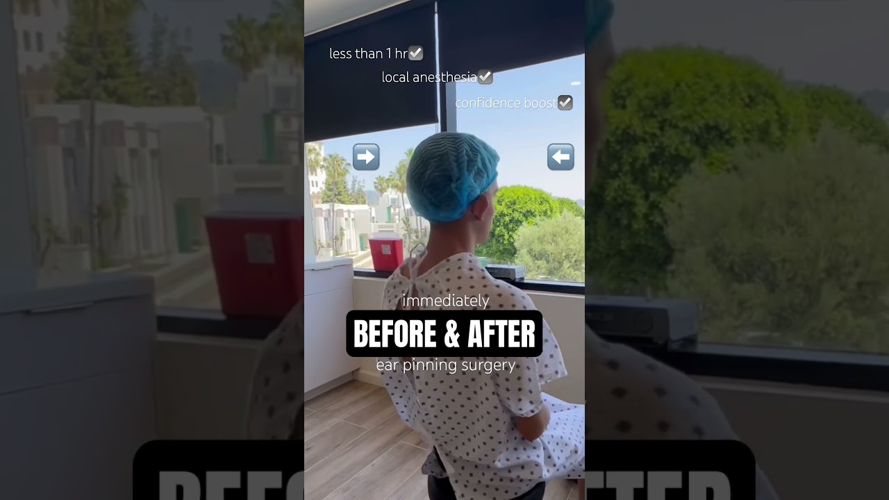 Ear Pinning Surgery BEFORE & AFTER #otoplasty #cosmeticsurgery #beforeandafter #confidence