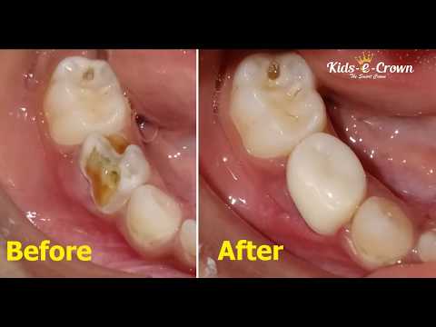 Zirconia Crown Kit at Best Price in India