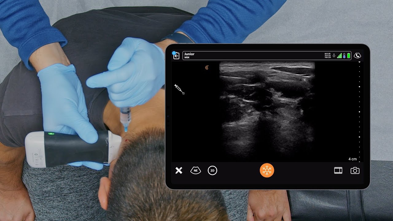 USG Greater Occipital Nerve Block