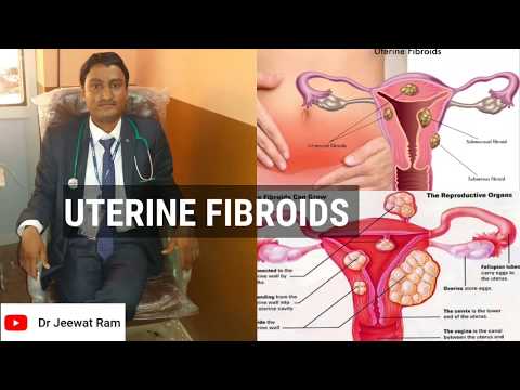 UTERINE FIBROIDS, CAUSES,SIGNS, SYMPTOMS, DIAGNOSIS AND MANAGEMENT