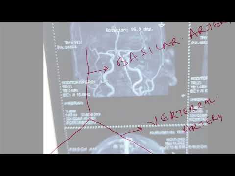 Right vertebral artery occlusion
