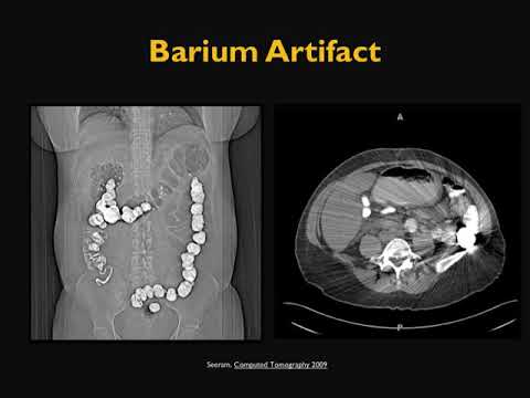 CT Artifacts Patient-based Artifacts