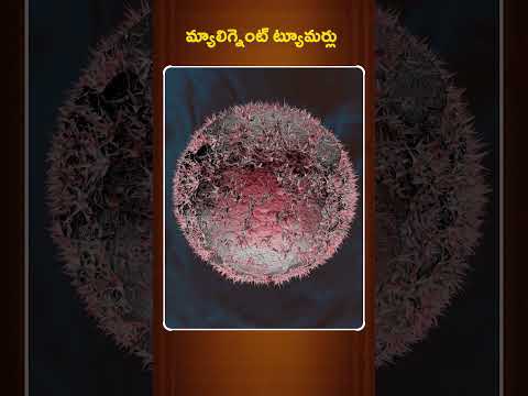 కణతులు ఎందుకు వస్తాయి? వస్తే ఏమౌతుంది | Malignant tumors are a primary cause of cancer?| Nature Cure