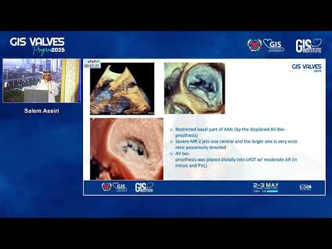 Salem Assiri PVL in Low Seated Valve