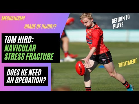 Navicular Stress Fracture: Essendon Bomber's Tom Hird - Injury Analysis