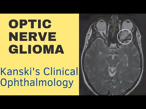 Optic Nerve Glioma-Kanski's clinical ophthalmology #optic nerve tumor #ocular tumor #eye cancer