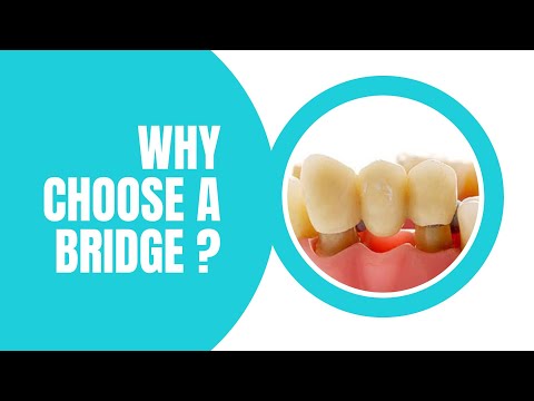 Why choose a bridge? Tooth replacement options explained