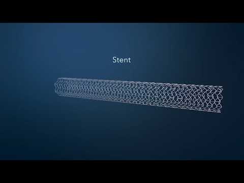 Alap Jani, MD - Stent Placement