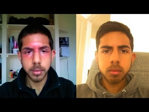 Eczema | Dermatitis | Psoriasis - What's the Difference??