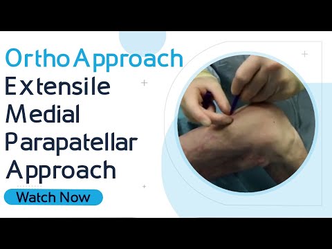 Extensile Medial Parapatellar Approach • Video • MEDtube.net