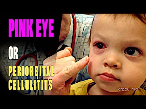 LIVE DIAGNOSIS: Pink Eye or Periorbital Cellulitis? | Dr. Paul