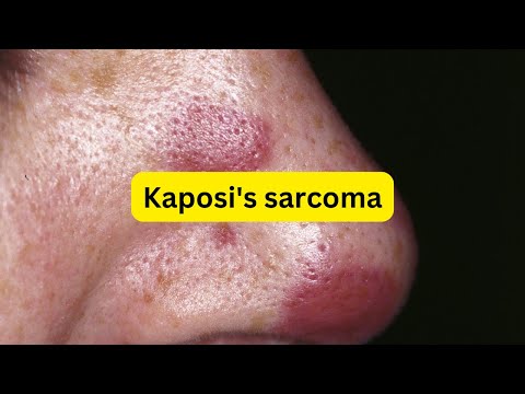 What is kaposi's sarcoma?