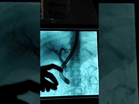 ERCP procedure Liver Biliary system | Radiology | Gastroenterology