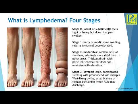 The Vital Role of Specialty Footwear in Lower Limb Lymphedema Management