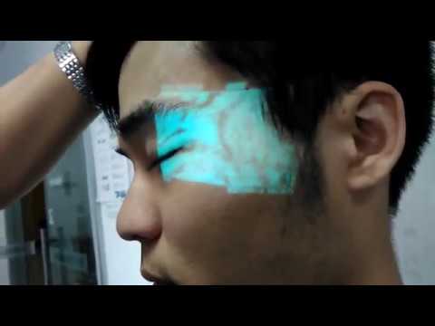 VS-300 vein finder Application on face