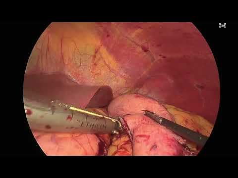 LAPAROSCOPIC SLEEVE GASTRECTOMY WITH STAPLE-LINE OVERSEWING IN PATIENT WITH FACTOR XI DEFICIENCY