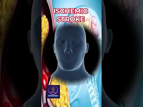 Ischemic Stroke: Cerebral Arteries Blood Flow Blocked by a Clot
