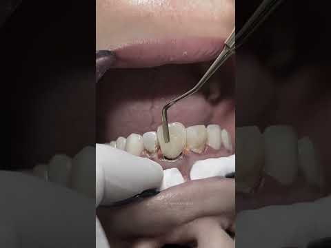 Composite restoration with fiber post before the zirconia crowns for all anterior teeth #dentist